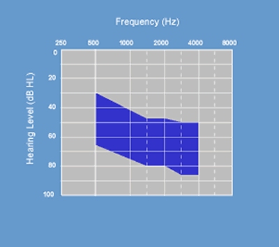 Vibrant Soundbridge | Ear Institute of Chicago